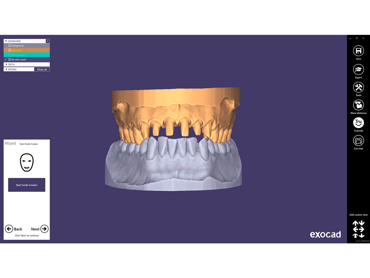 exocad Smile Creator Module | Gold Quadrat Dental