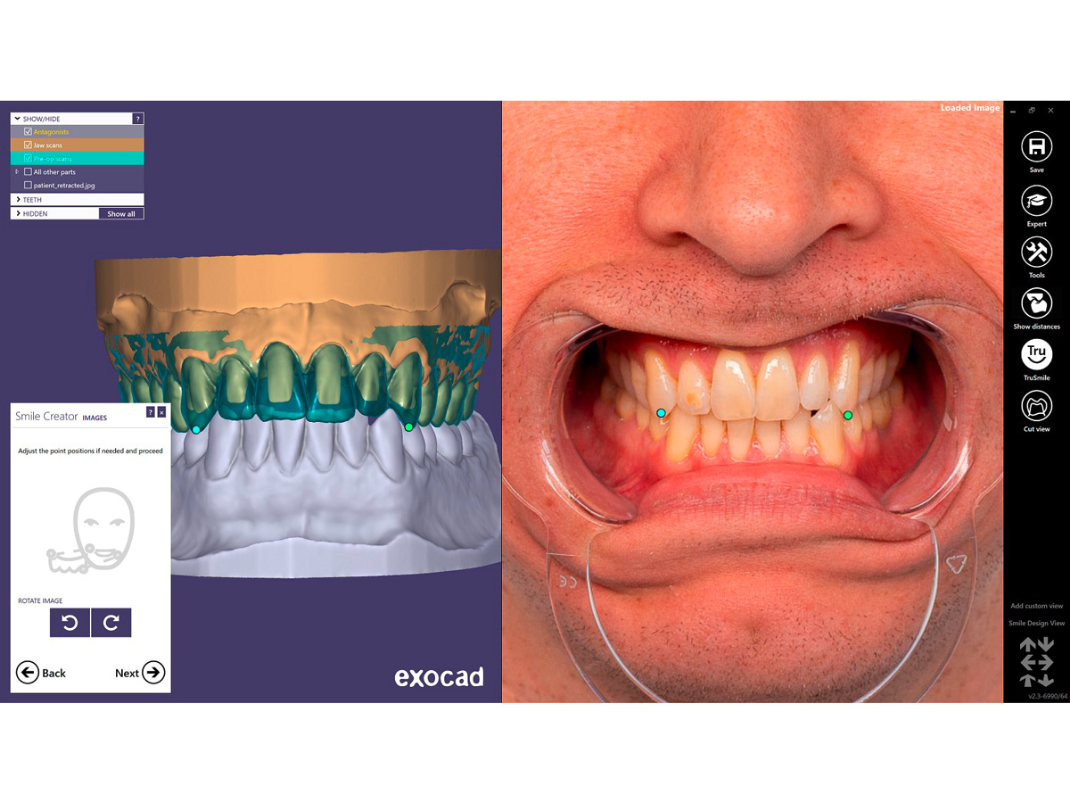 exocad Smile Creator Module | Gold Quadrat Dental