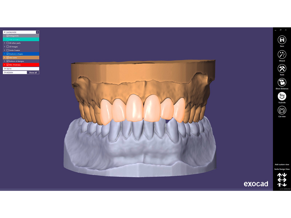 exocad Smile Creator Module | Gold Quadrat Dental