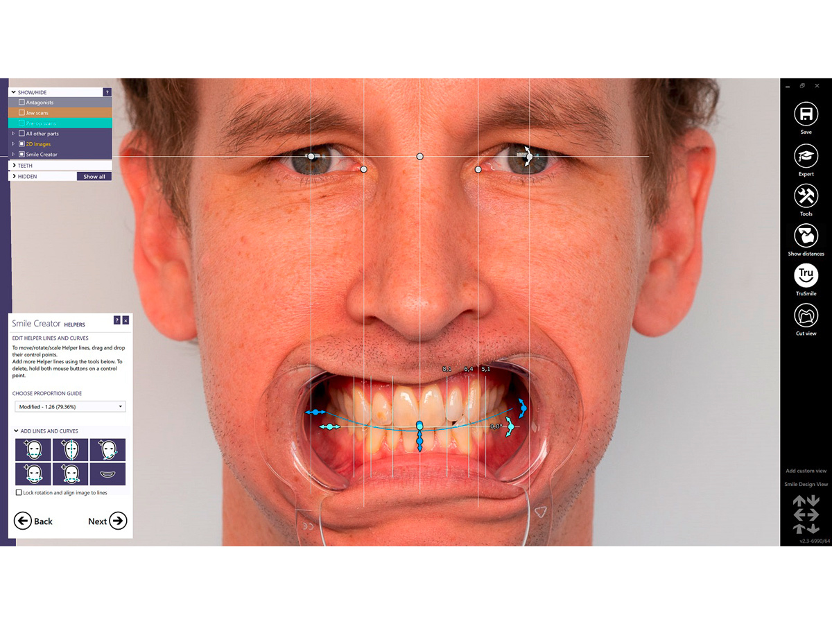 exocad Smile Creator Module | Gold Quadrat Dental