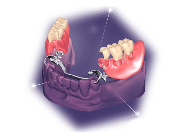exocad PartialCAD Module | Gold Quadrat Dental