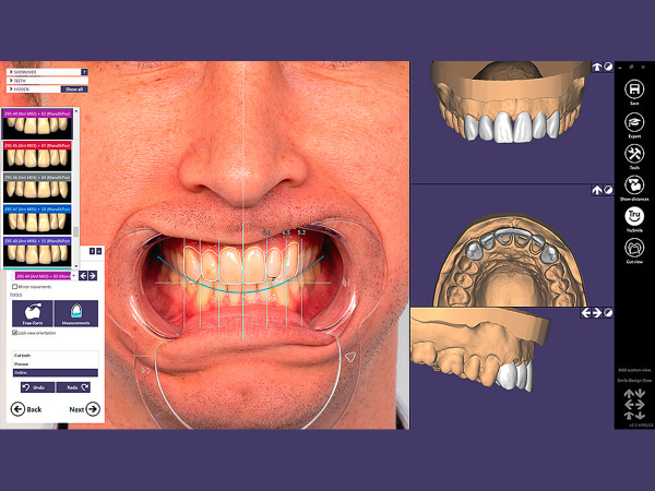 exocad Tooth Library ZRS | Gold Quadrat Dental