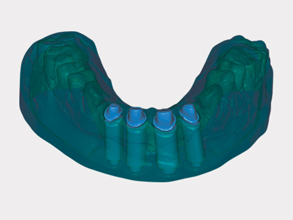 exocad Model Creator | Gold Quadrat Dental