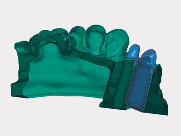 exocad Model Creator | Gold Quadrat Dental